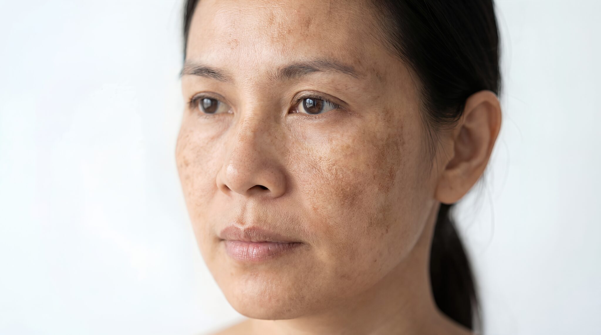 Choosing the Best Sunscreen for Melasma-Prone Skin